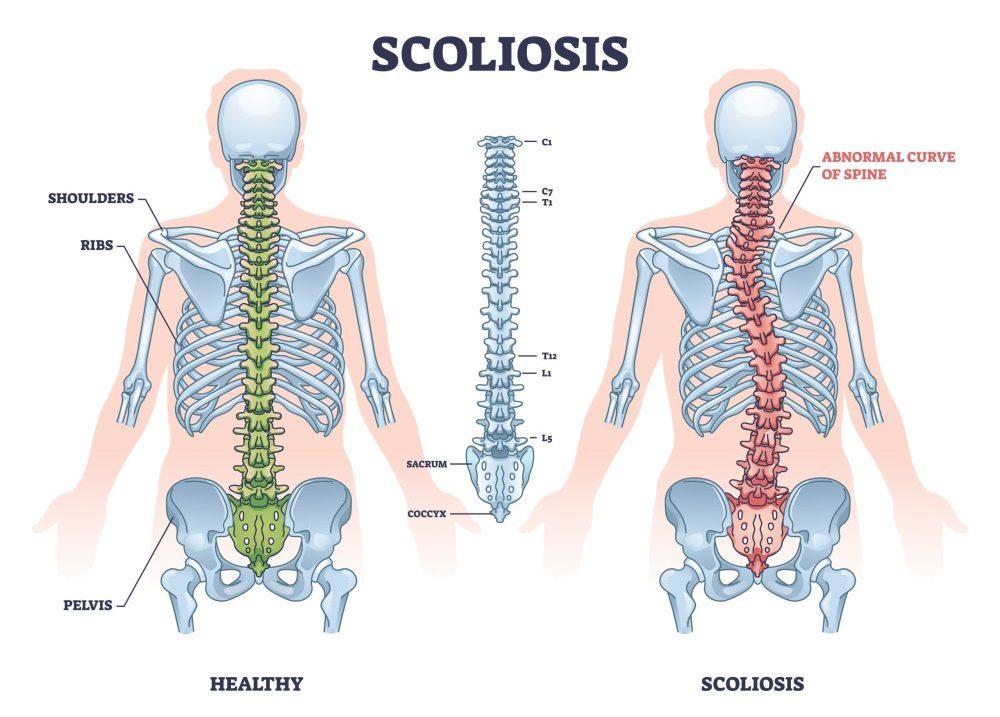 Scoliosis Treatment Groton CT | Non‑Surgical Spine Care