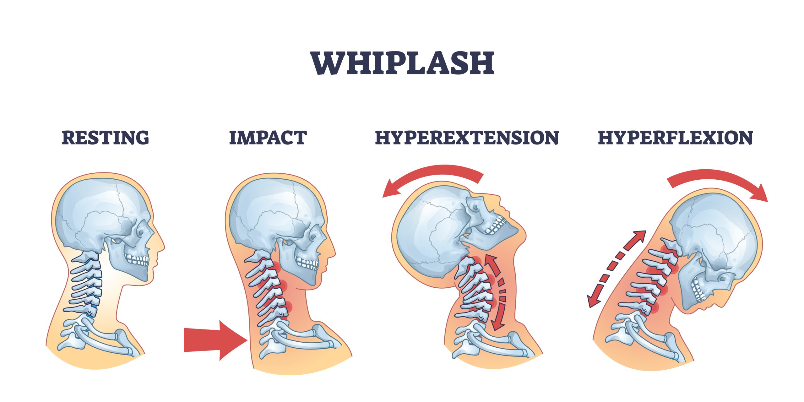 Auto Accident & Whiplash Care Groton CT | Pain Relief